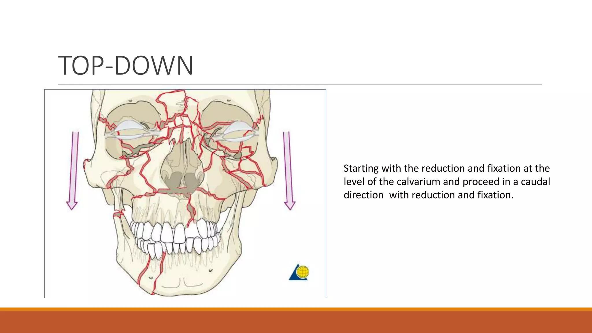Management of Panfacial Fractures(1).pptx