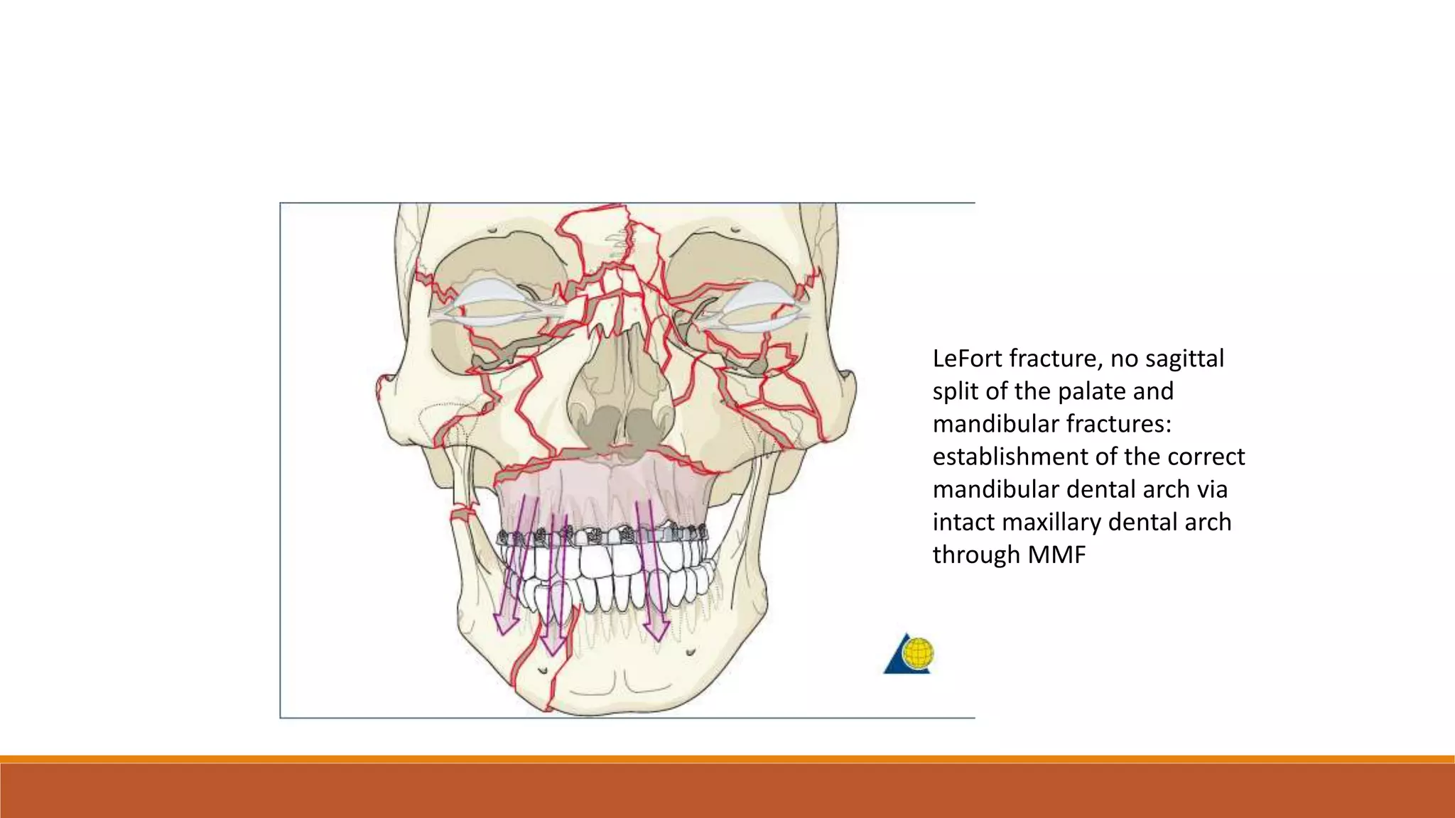 Management of Panfacial Fractures(1).pptx