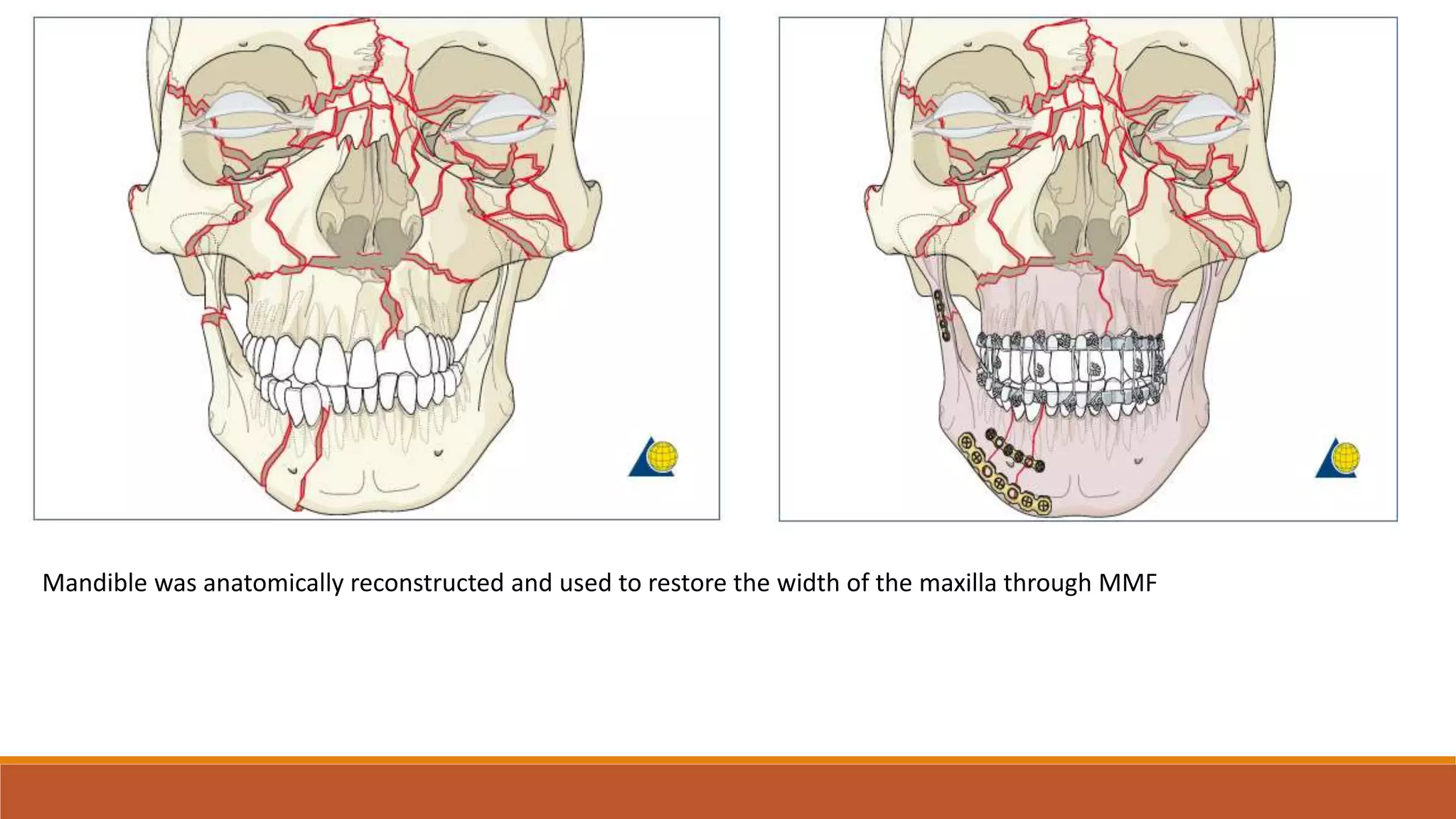 Management of Panfacial Fractures(1).pptx