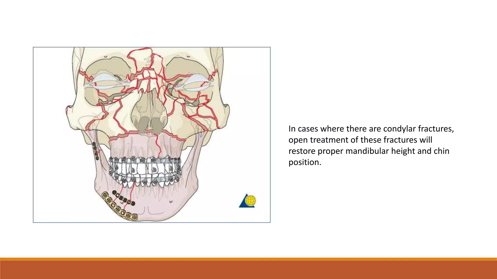 Management of Panfacial Fractures(1).pptx