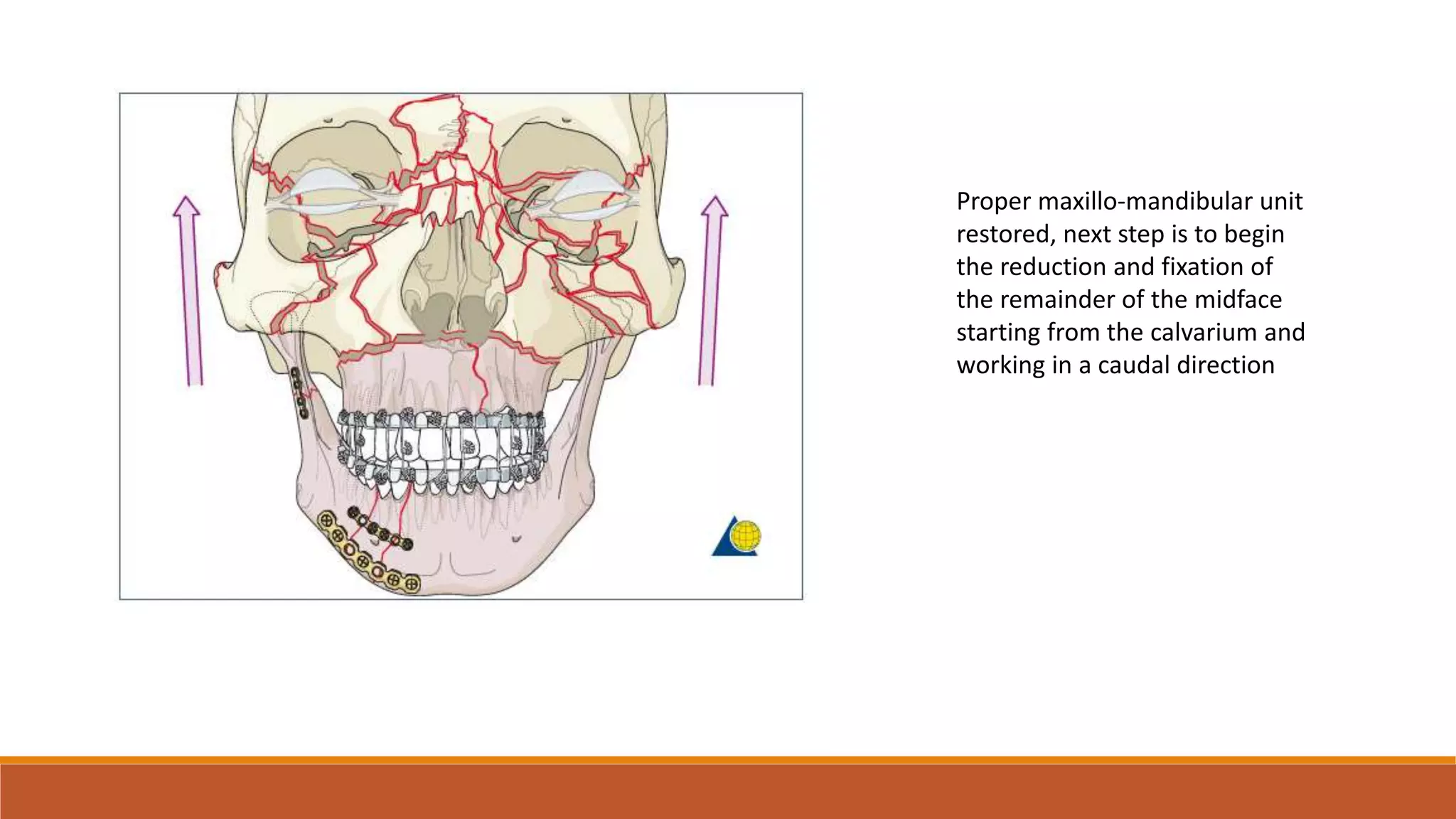 Management of Panfacial Fractures(1).pptx