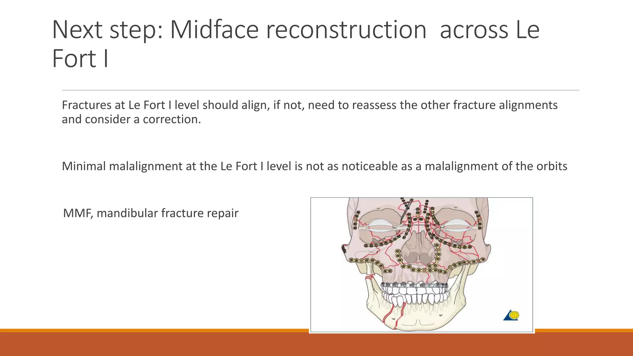 Management of Panfacial Fractures(1).pptx