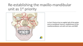 Management of Panfacial Fractures(1).pptx