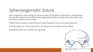 Management of Panfacial Fractures(1).pptx