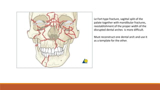 Management of Panfacial Fractures(1).pptx