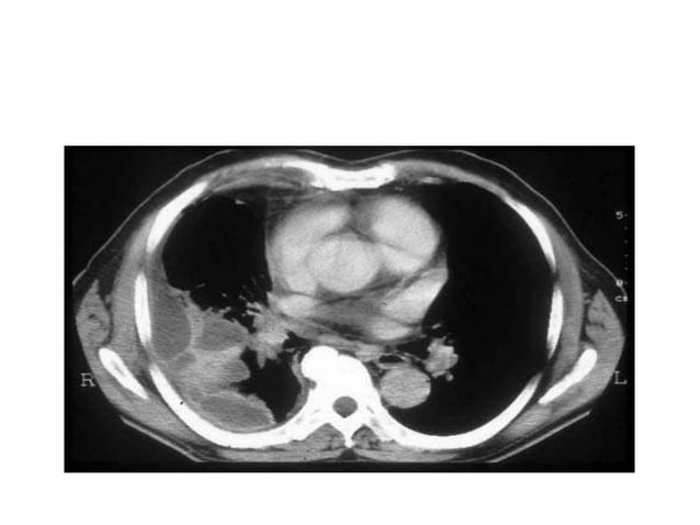 Management of Parapneumonic Effusion and Empyema | PPTX