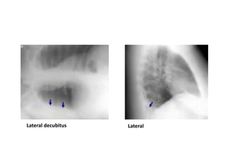 Management of parapneumonic effusion and empyema | PPTX