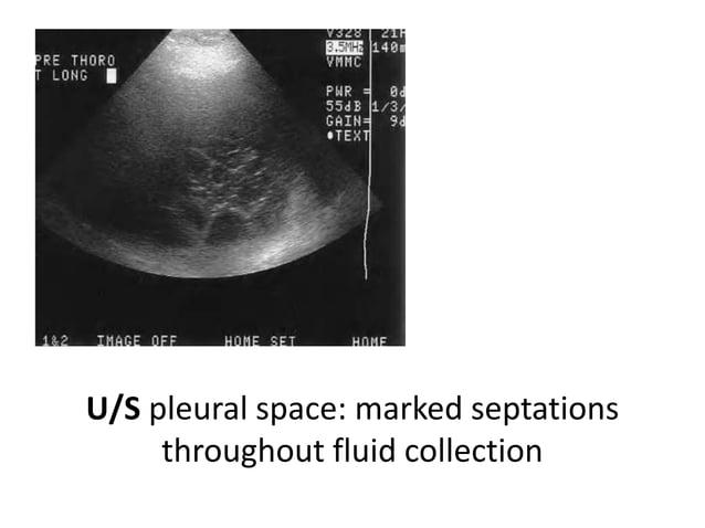 Management of parapneumonic effusion and empyema | PPTX