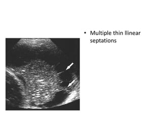 Management of parapneumonic effusion and empyema | PPTX
