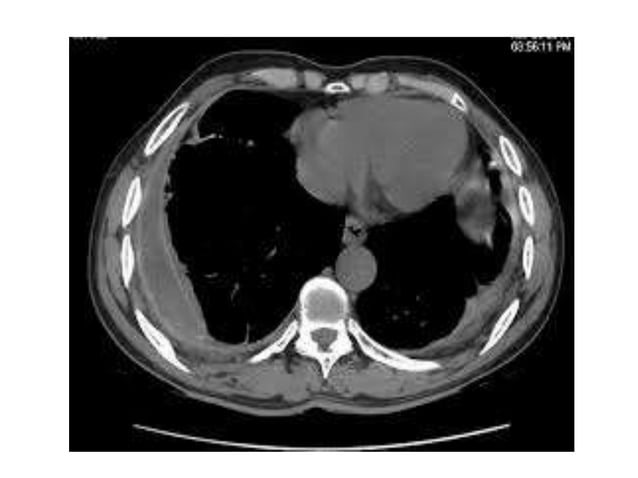 Management of parapneumonic effusion and empyema | PPTX