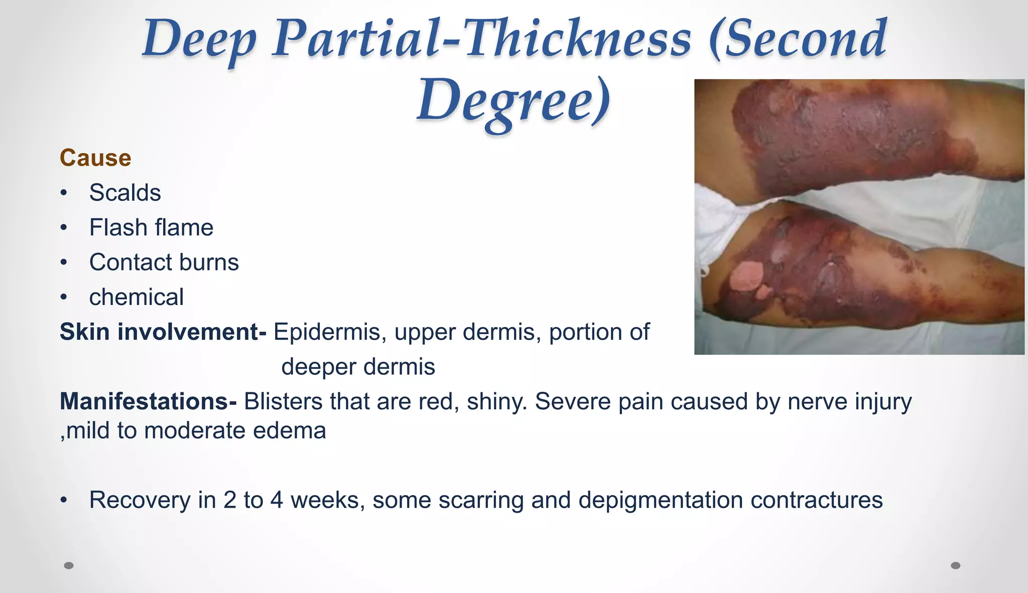 Management of patient with burns | PPTX
