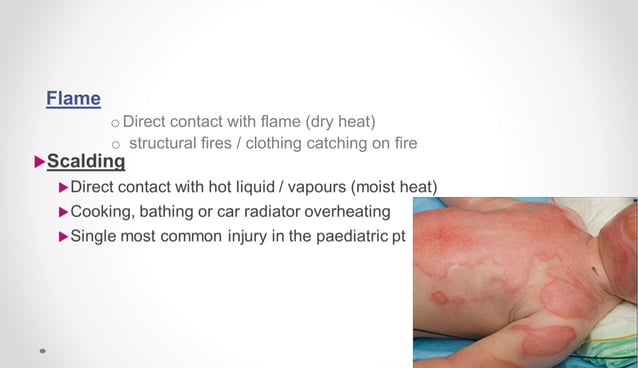 Management of patient with burns | PPTX | First Aid | Injuries