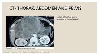 Management of patient with right upper quadrant pain. (desmoplastic ...