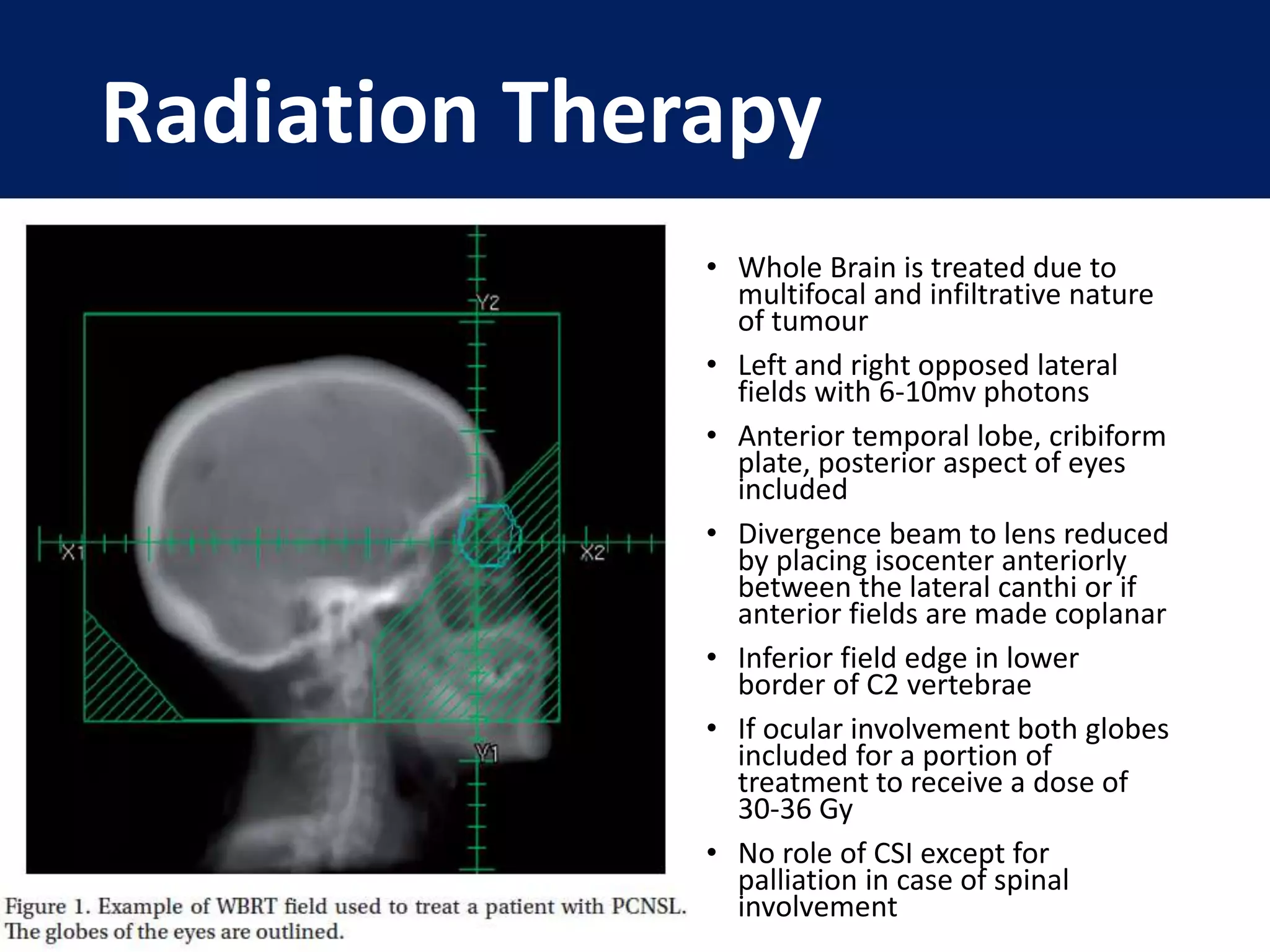Management of Primary CNS Lymphoma (PCNSL) | PPTX