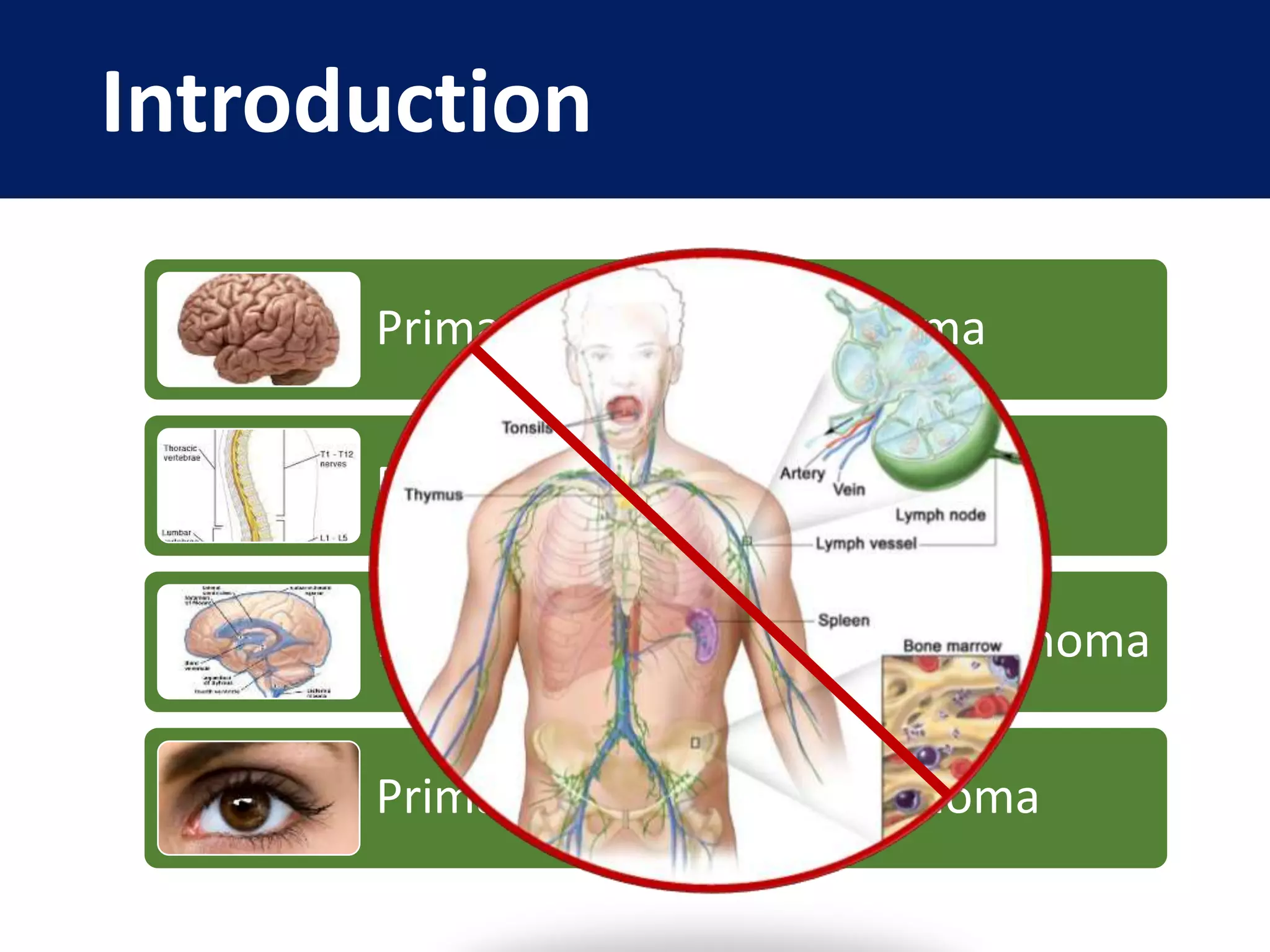 Management of Primary CNS Lymphoma (PCNSL) | PPTX