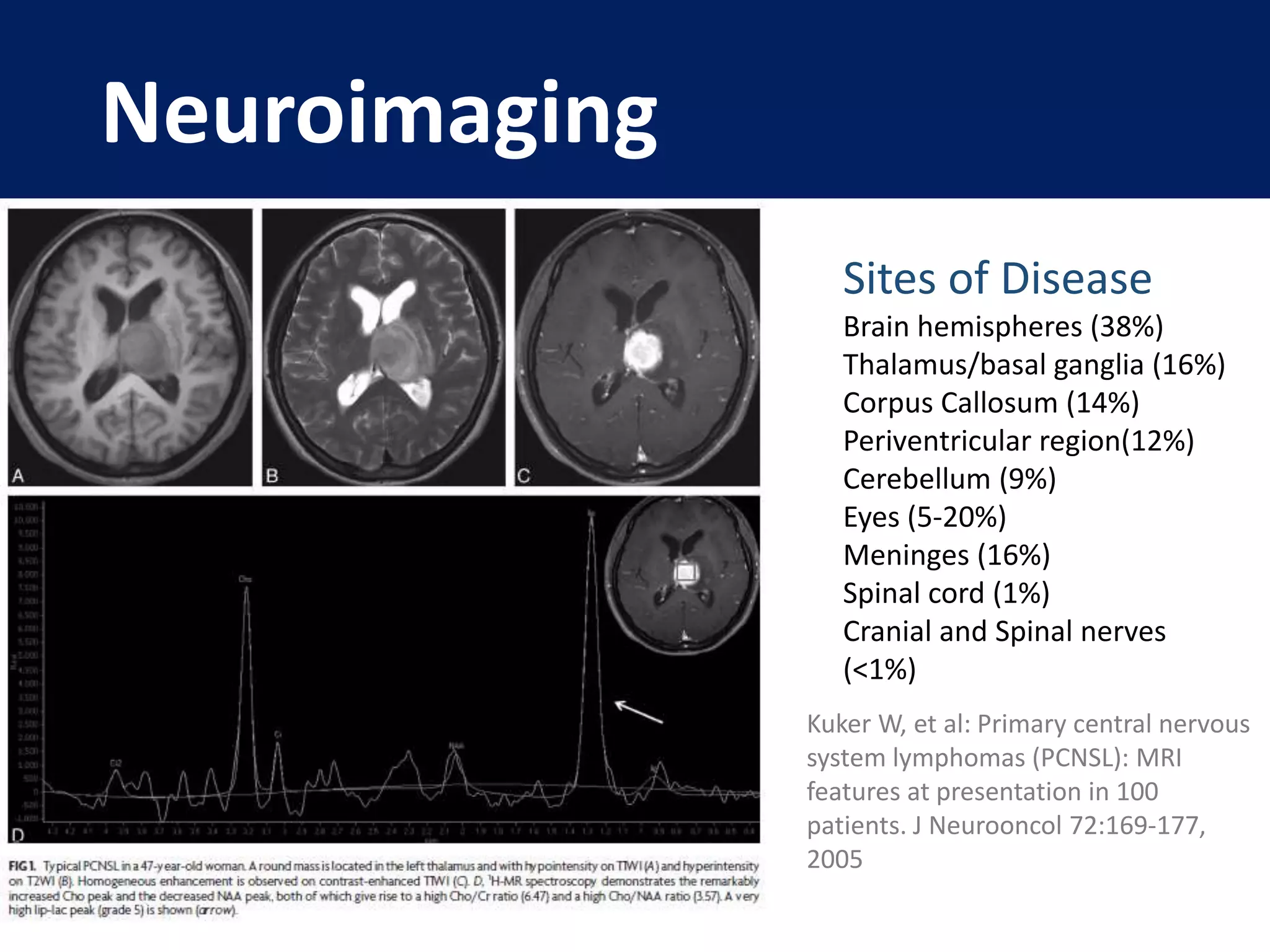 Management of Primary CNS Lymphoma (PCNSL) | PPTX
