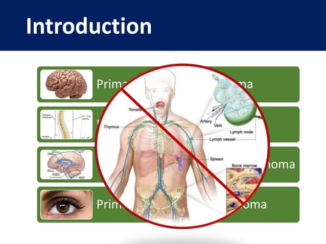 Management of Primary CNS Lymphoma (PCNSL) | PPTX