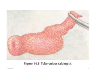 Management of pelvic tuberculosis | PPT