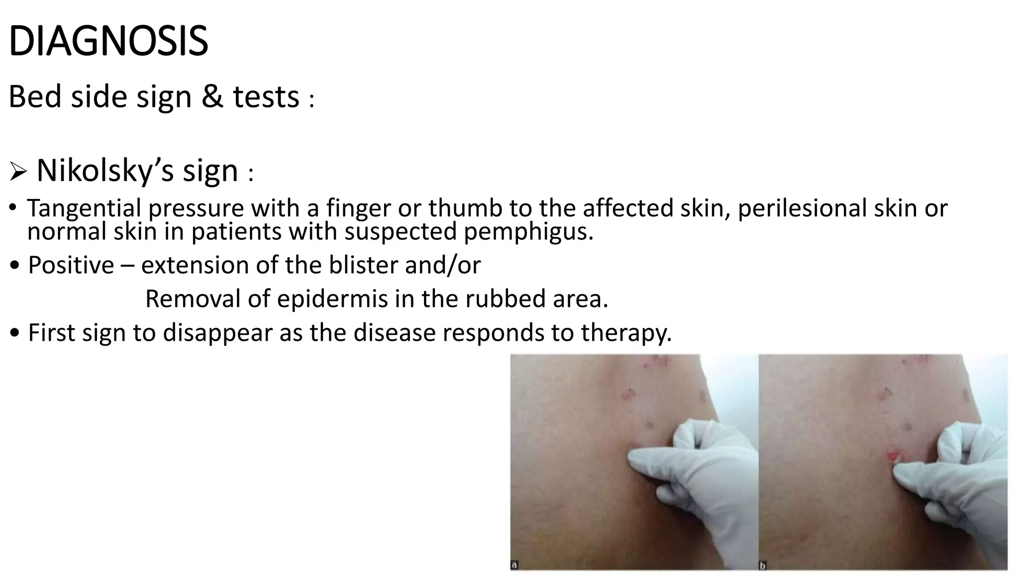 management of pemphigus ppt.pptx