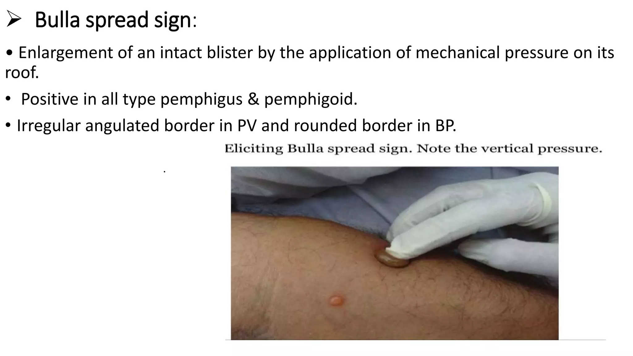 management of pemphigus ppt.pptx