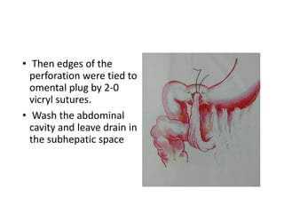 Management of perforated giant duodenal ulcer and patch failure.pptx