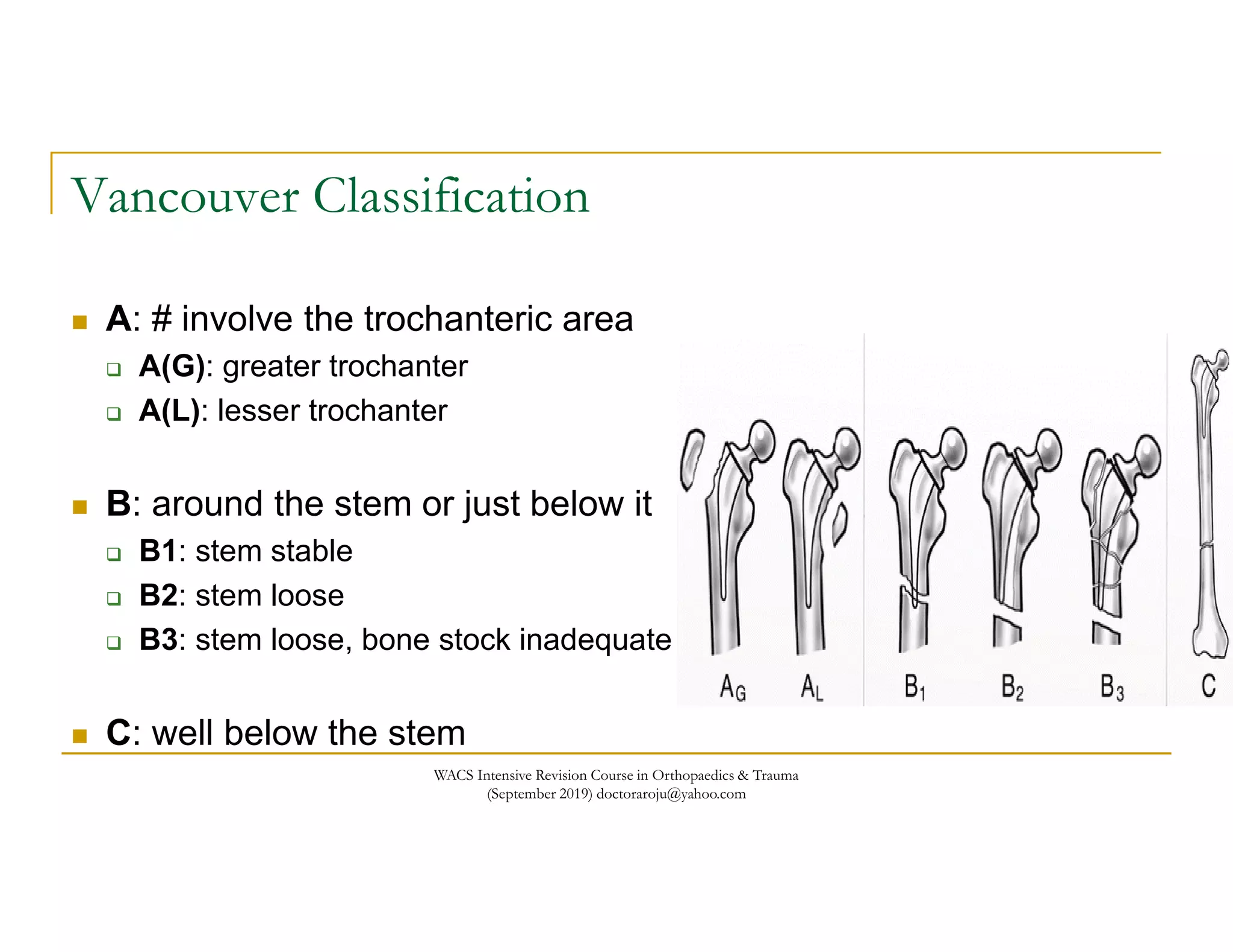 Management of peri prosthetic fractures | PDF