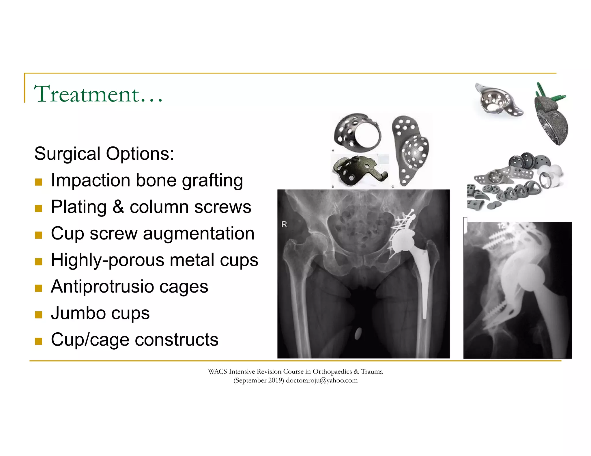 Management of peri prosthetic fractures | PDF