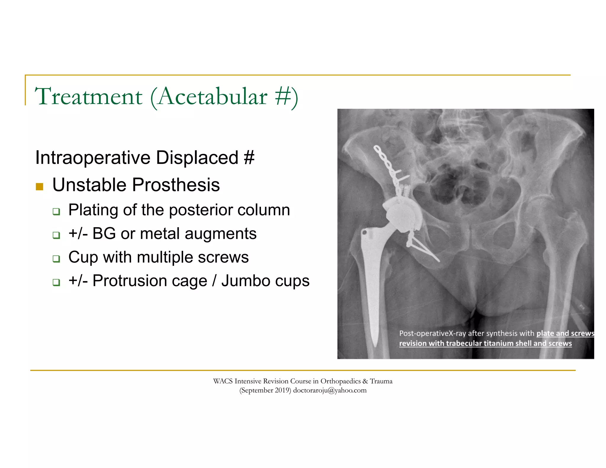 Management of peri prosthetic fractures | PDF