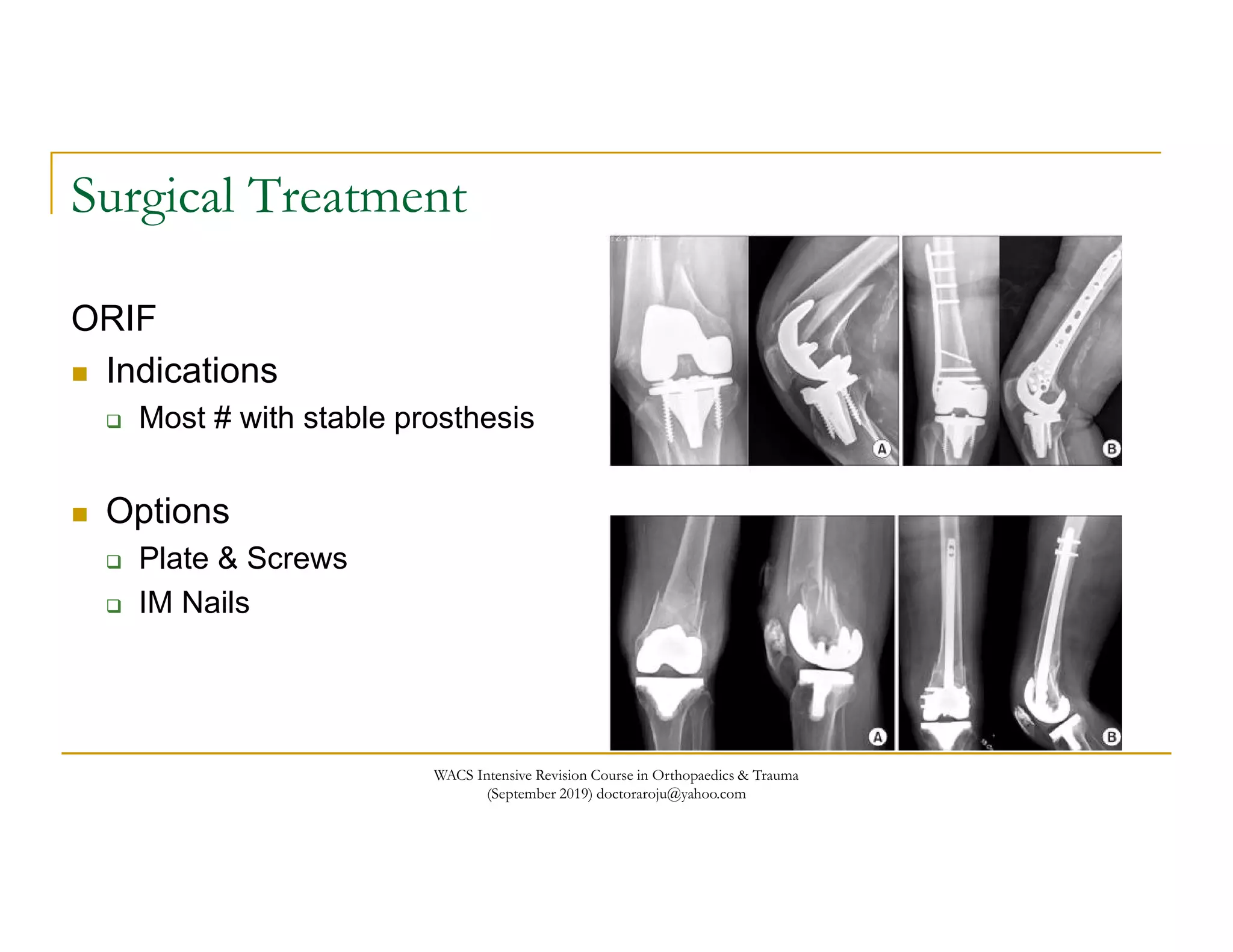 Management of peri prosthetic fractures | PDF