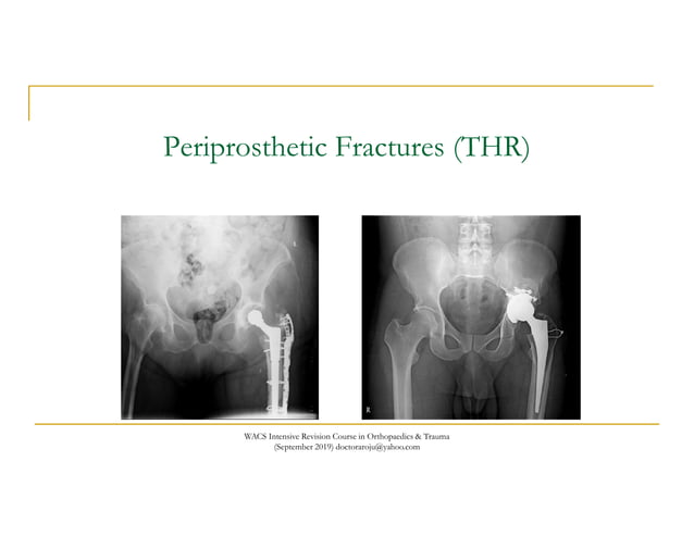 Management of peri prosthetic fractures | PDF