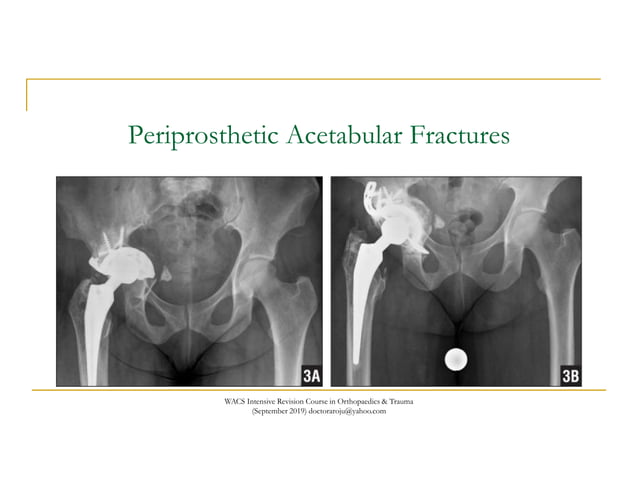 Management of peri prosthetic fractures | PDF