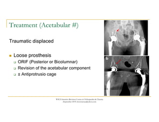 Management of peri prosthetic fractures | PDF
