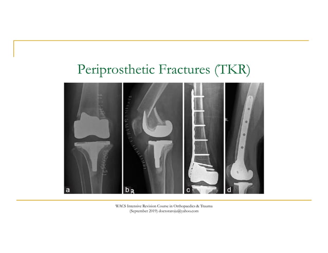 Management of peri prosthetic fractures | PDF