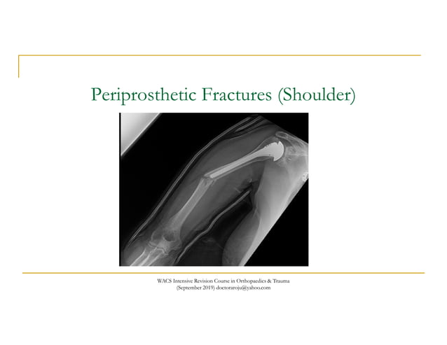 Management of peri prosthetic fractures | PDF