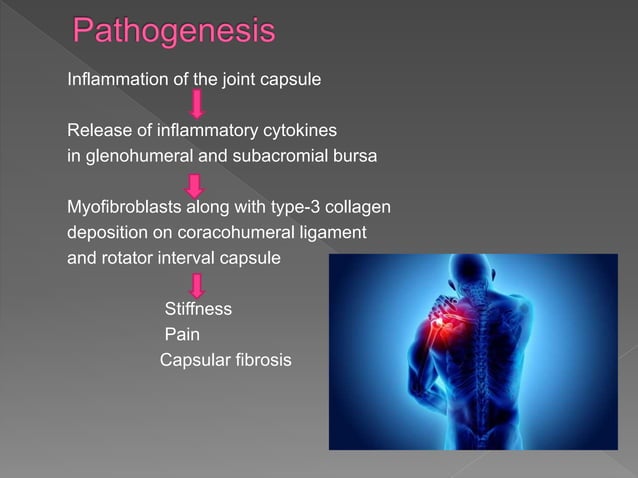 Management of periarthritis of shoulder joint by suprascapular nerve ...