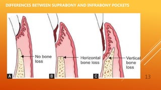 Management of Periodontal Pockets | PPTX