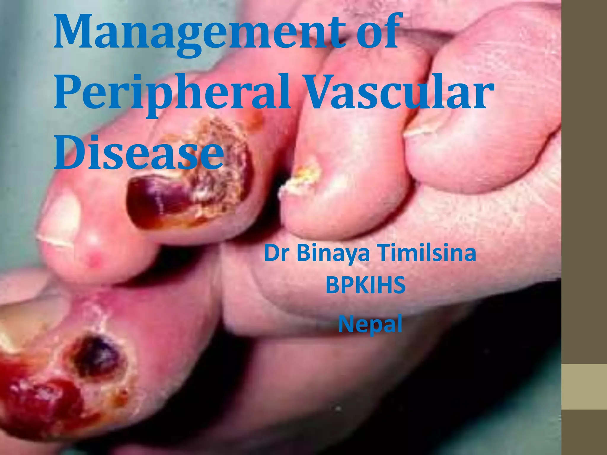 Management of peripheral vascular disease Dr Binaya Timilsina | PPTX | Heart and Cardiovascular ...