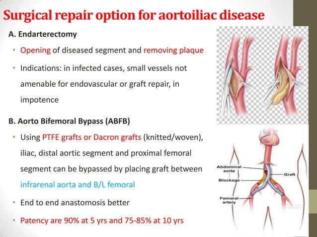Management of peripheral vascular disease Dr Binaya Timilsina | PPTX | Heart and Cardiovascular ...