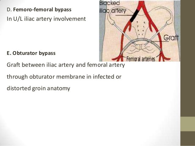 Management of peripheral vascular disease Dr Binaya Timilsina