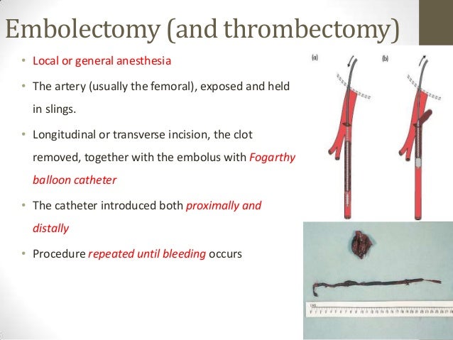 Management of peripheral vascular disease Dr Binaya Timilsina