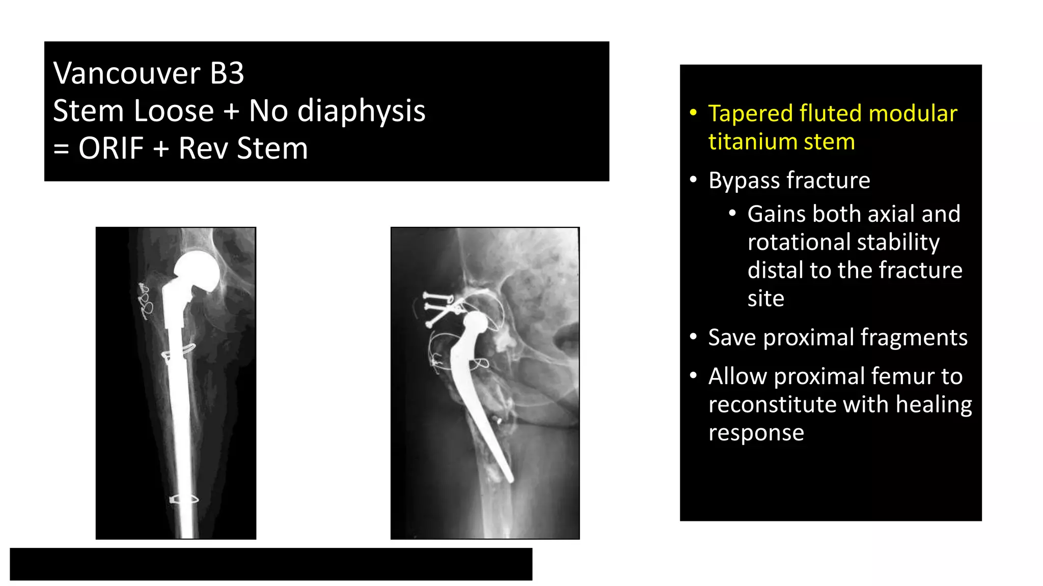 Management of periprosthetic fracture | PDF