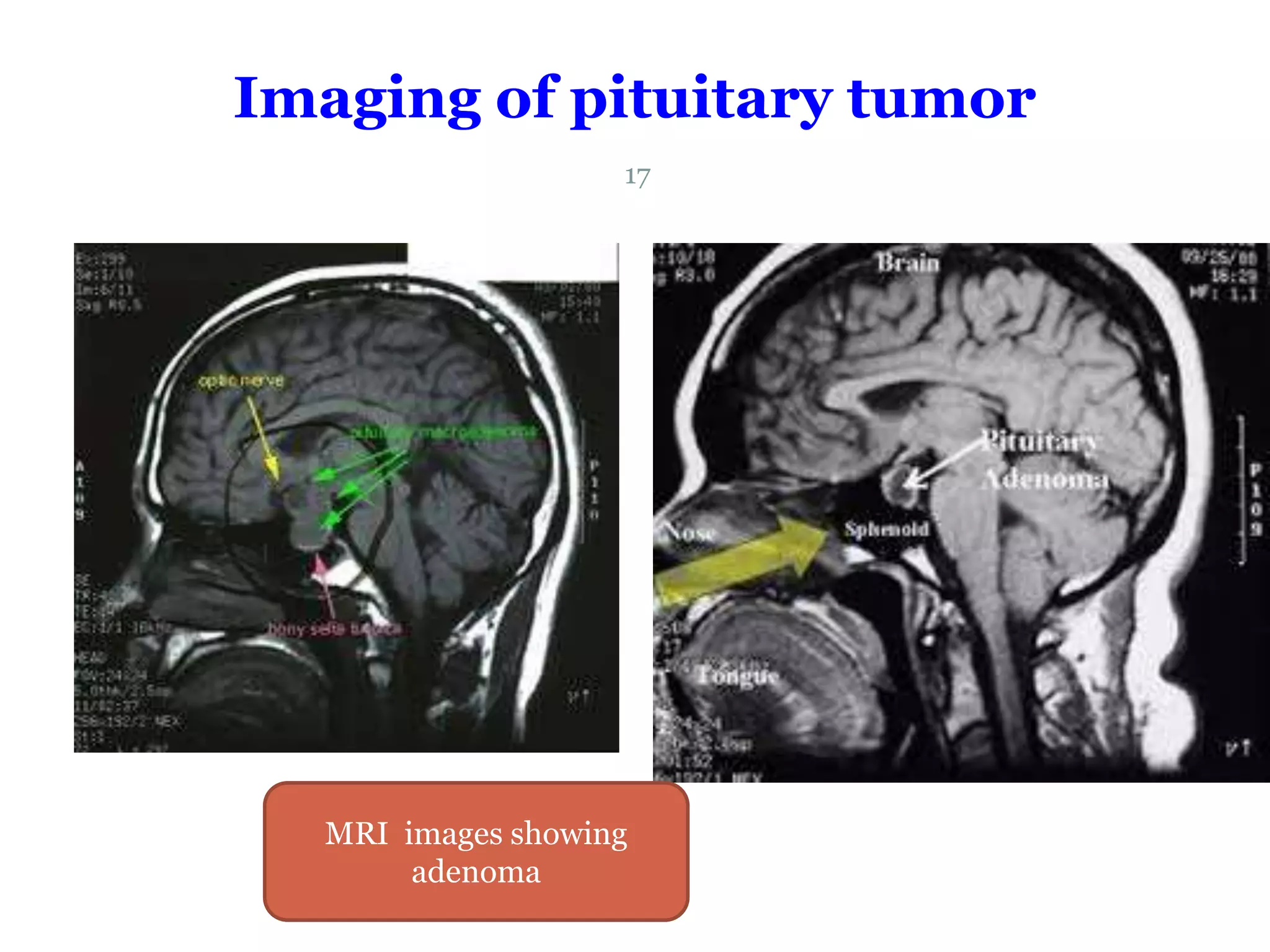 MANAGEMENT OF PITUITARY TUMORS.pptx