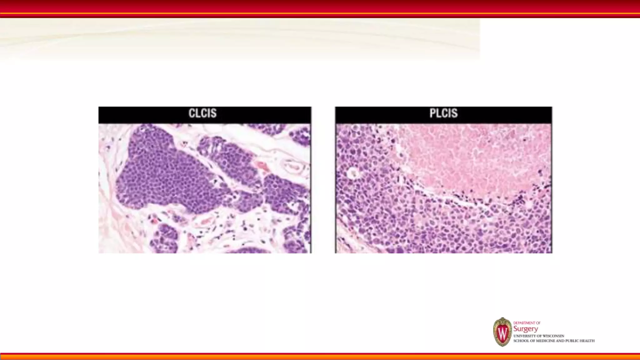 Management of pleomorphic lcis | PPTX