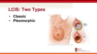Management of pleomorphic lcis | PPT
