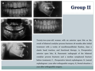 Management of posttraumatic malocclusion caused by condylar process ...