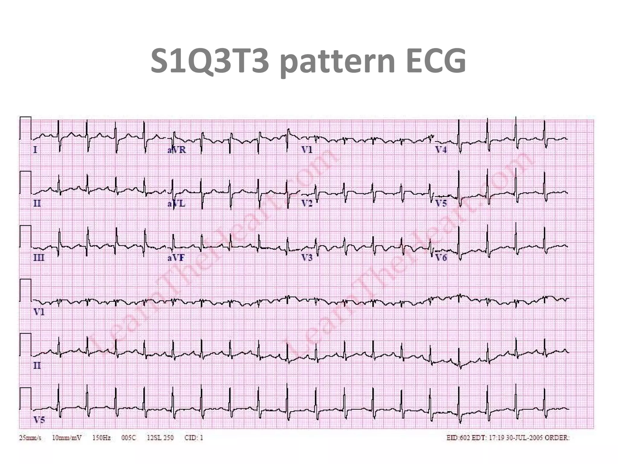 Management of pulmonary embolism in emergency department | PPT
