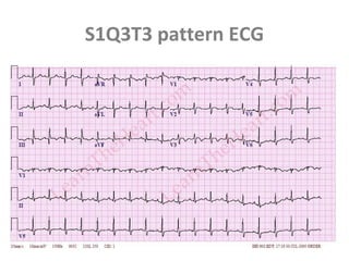 Pulmonary embolism in Emergency Department v2.0 | PPT
