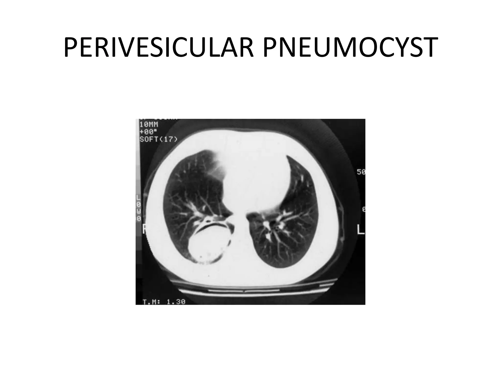 Management of pulmonary hydatid disease | PPTX