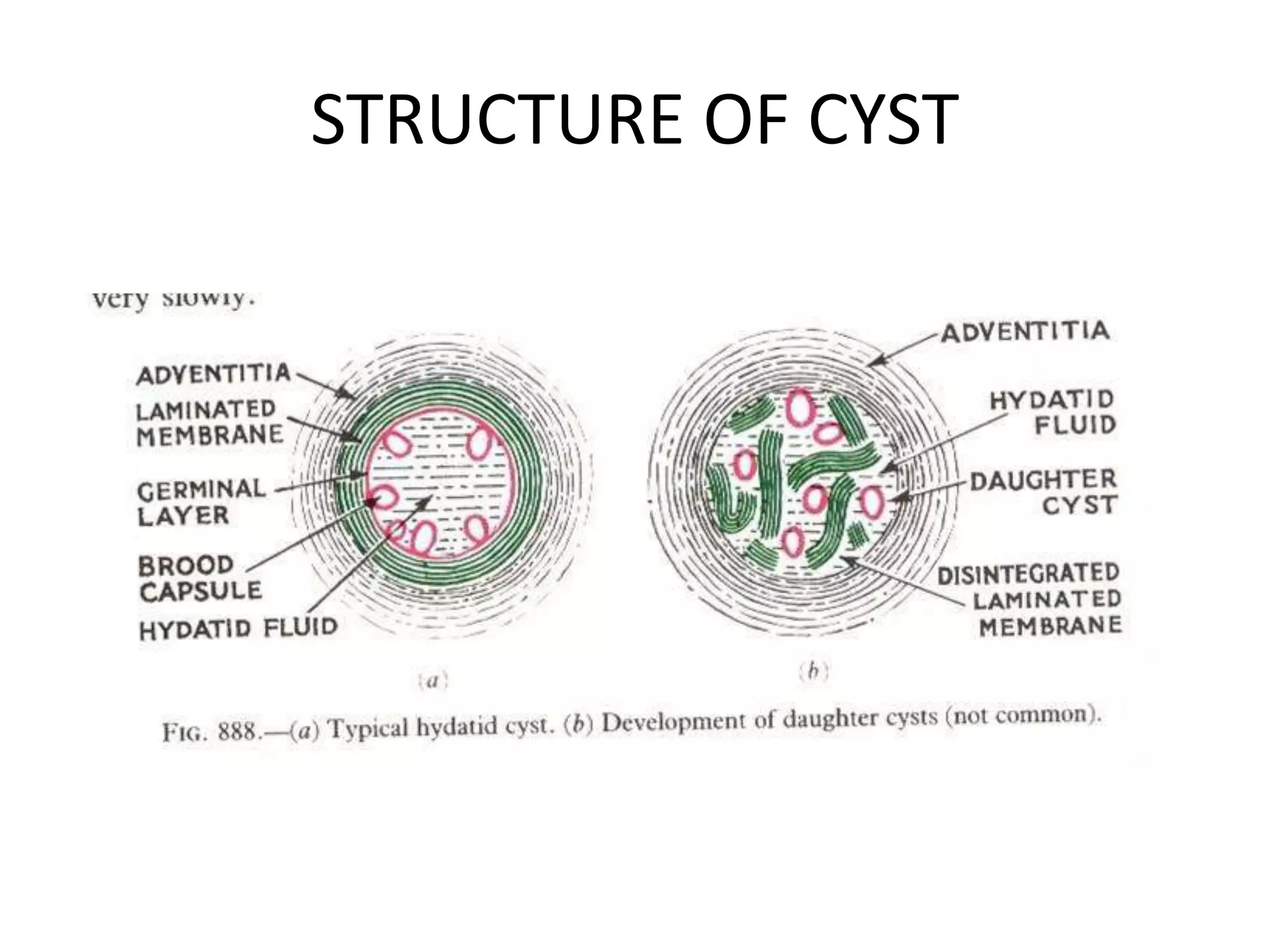 Management of pulmonary hydatid disease | PPTX