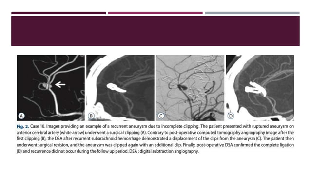Management of Recurrent Cerebral Aneurysm after Surgical Clipping.pptx